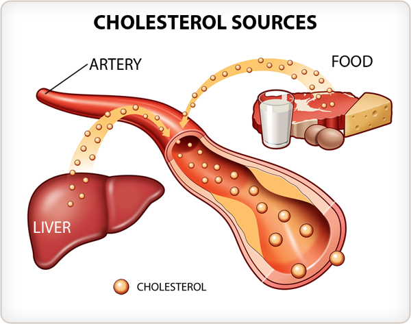 SOME PHYSICAL SIGNS SYMPTOMS OF HIGHT CHOLESTEROL - Health News