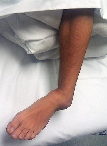 3° A Ensino Médio: Fratura Fechada