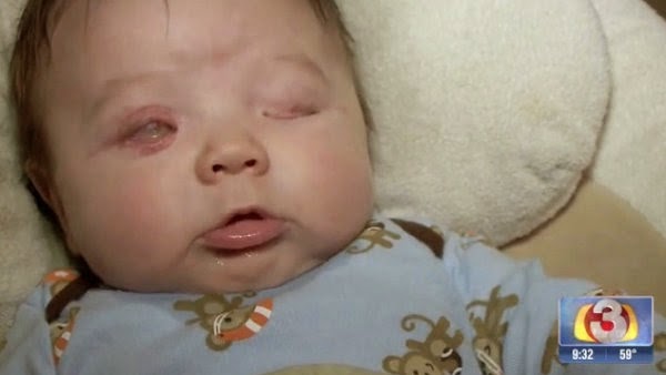 Eye Socket Without Eyeball