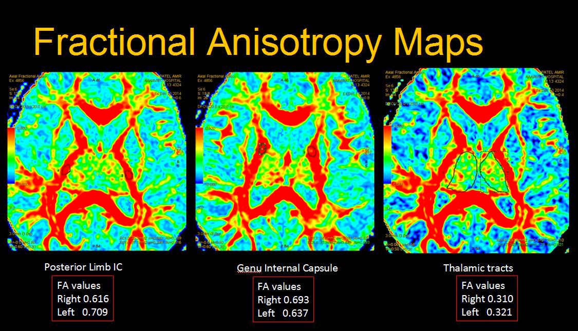 Dr Balaji Anvekar FRCR: Understanding Primary Dystonia with Advanced ...