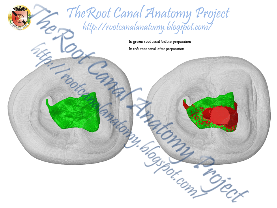 The Root Canal Anatomy Project: Conservative Endodontic Access ...