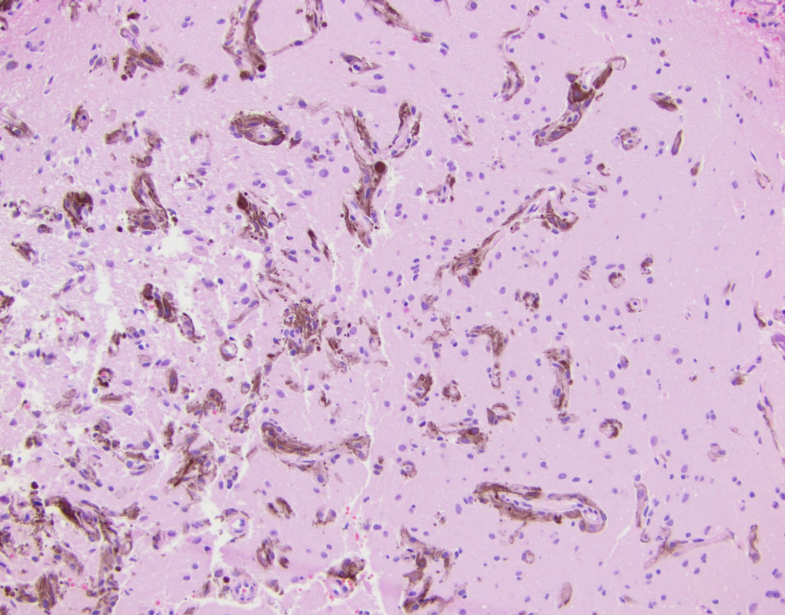 neuropathology blog: The Pigmented Cells of Metastatic Melanoma ...