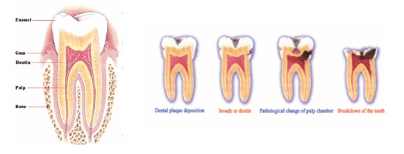 Dokter Gigi ANTONY: ENDODONTI (Perawatan Saluran Akar Gigi)