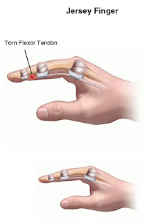 MYO Therapy & Healthcare Institute: Flexor Tendon Injuires