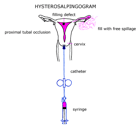 SUSU KAMBING MYMILA: KAEDAH RAWATAN UNTUK HAMIL‼ PAP SMEAR PERLU ...