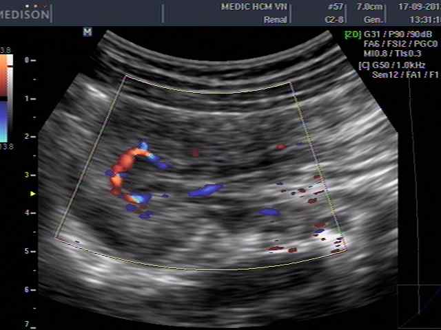 VIETNAMESE MEDIC ULTRASOUND: CASE 143: INTUSSUSCEPTION of COLON due to ...
