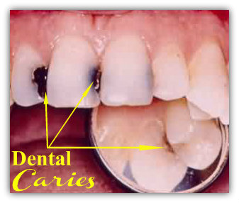 Indeks Karies Gigi (DMF-T, def-t) - Education Articles