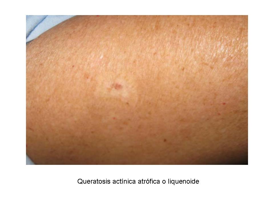 Queratosis actínica
