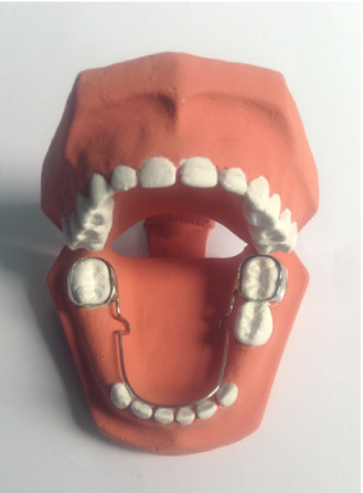 Prevención de maloclusiones_2: Arco Lingual - Indicaciones ...