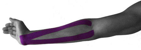 ARES Kinesiology Tape: Golf Elbow