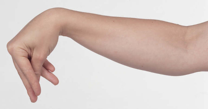 Tetany; Spasmophilia; Tetany, Neonatal