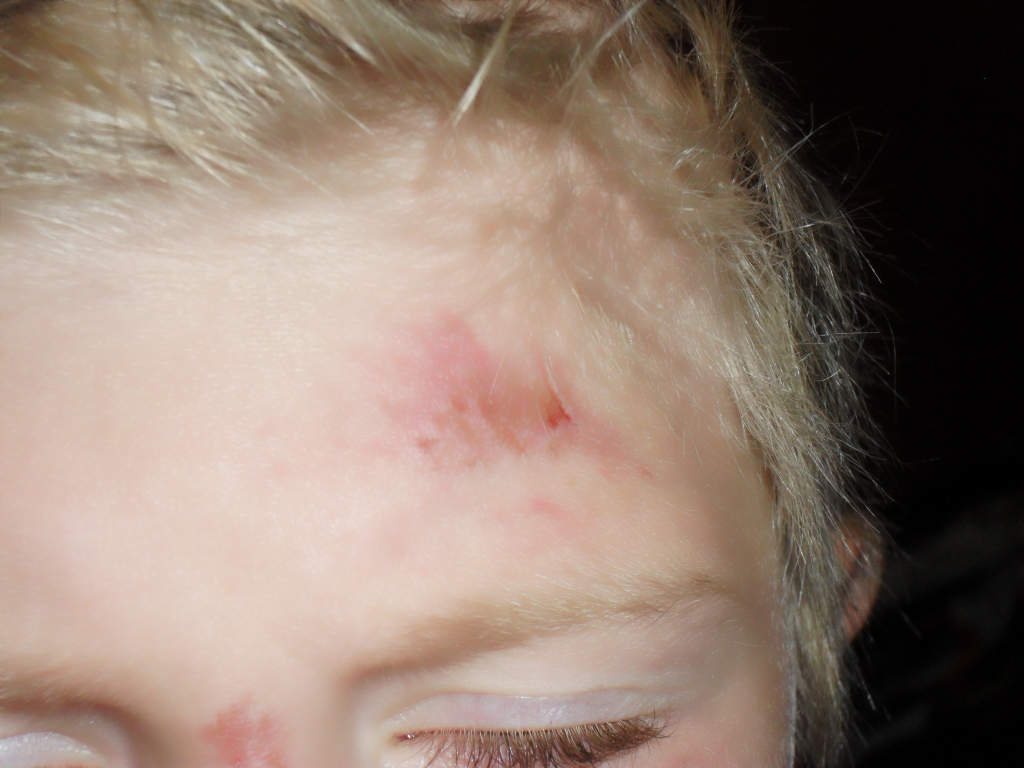 Road Rash.......and The Prickly Pear