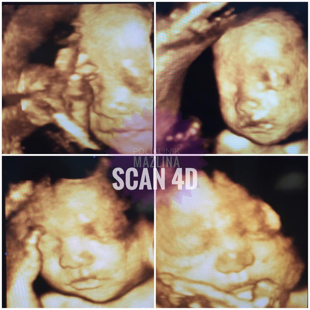 10 SOALAN POPULAR MENGENAI SCAN BAYI | Poliklinik Mazlina