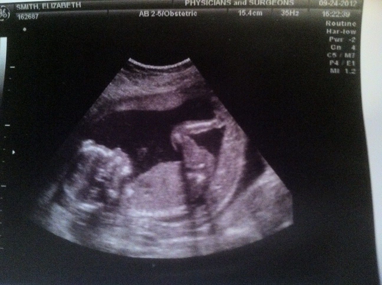 Out of the Blue: 17 Week Update and Anatomy Ultrasound