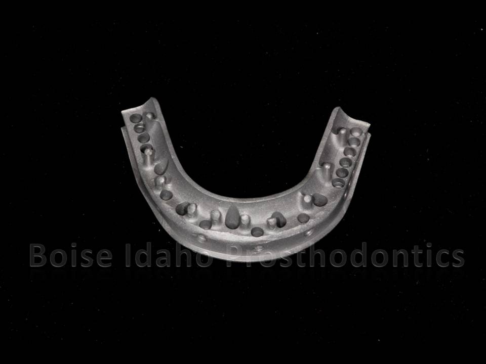 Boise Idaho Prosthodontics: Mandibular Hybrid Prosthesis Denture Tooth ...