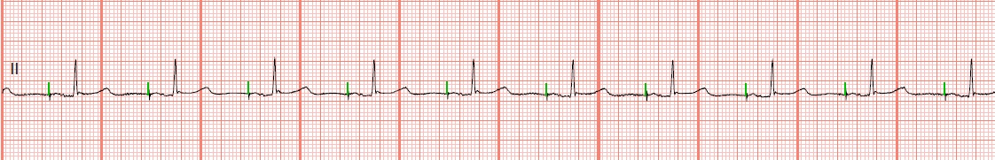 EKG Rhythm Strip Quiz 60