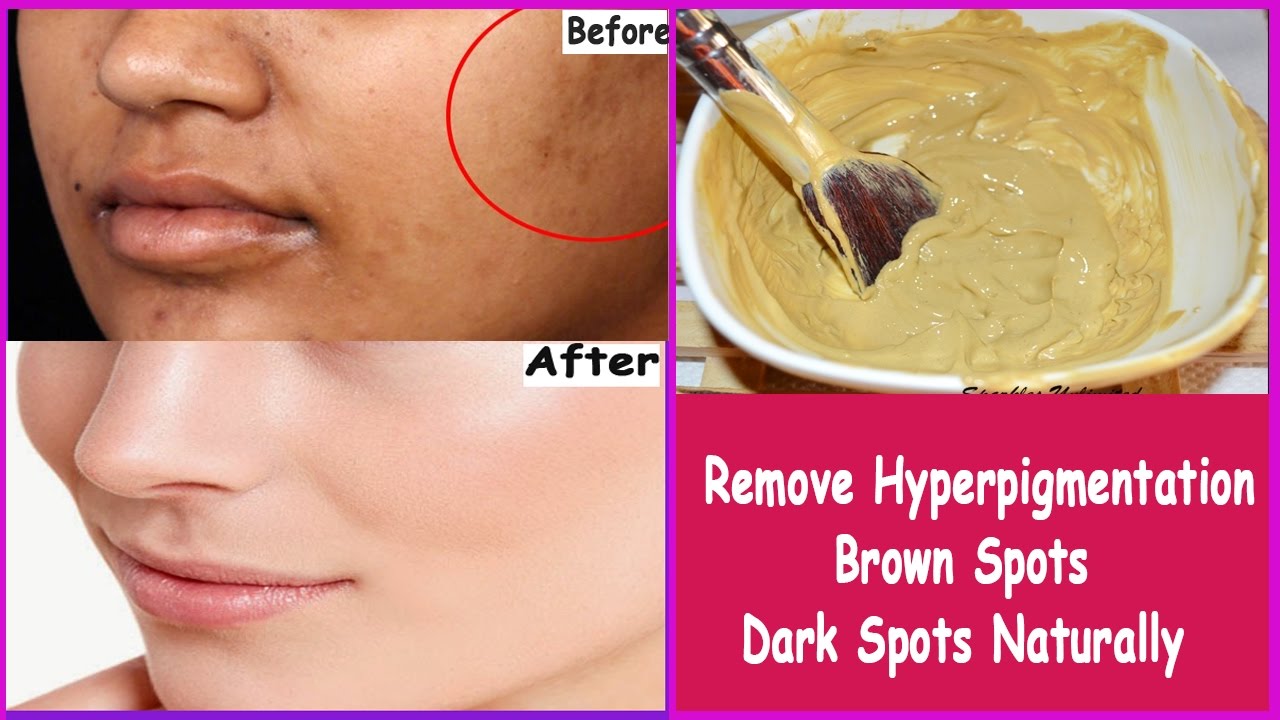 Natural Home Remedy To clear Your Skin Of Dark Spots Or ...