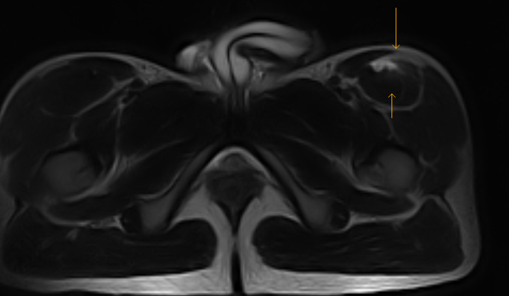 Rectus femoris Tear-MRI - Sumer's Radiology Blog