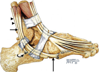 MRI Musculo-Skeletal Section: Peroneal tendon lesions.