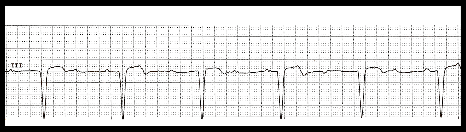Various Third Degree Heart Blocks