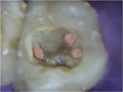 Davini - Endodontia e Microscopia Operatória: Tratamento endodôntico ...