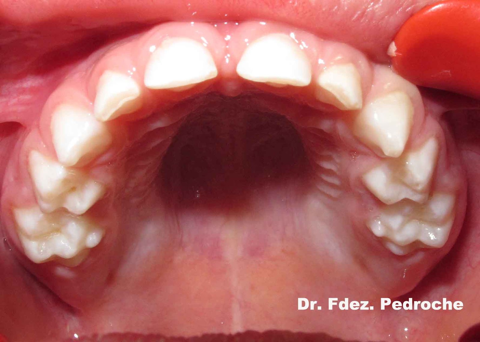 Una Boca para toda la Vida: ¿Como funciona la boca de los 3 a los 6 años?