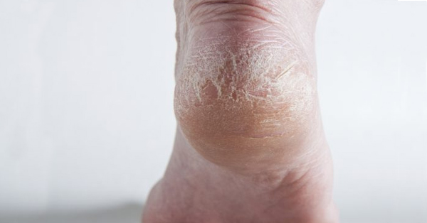 Here's How To Treat Cracked Feet And How They Can Be Prevented