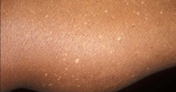 VIVA JOY HEALTH: Skin Fungi Infections