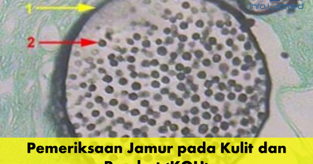 Pemeriksaan Jamur pada Kulit dan Rambut (KOH) | Seri Edukasi Teknologi ...