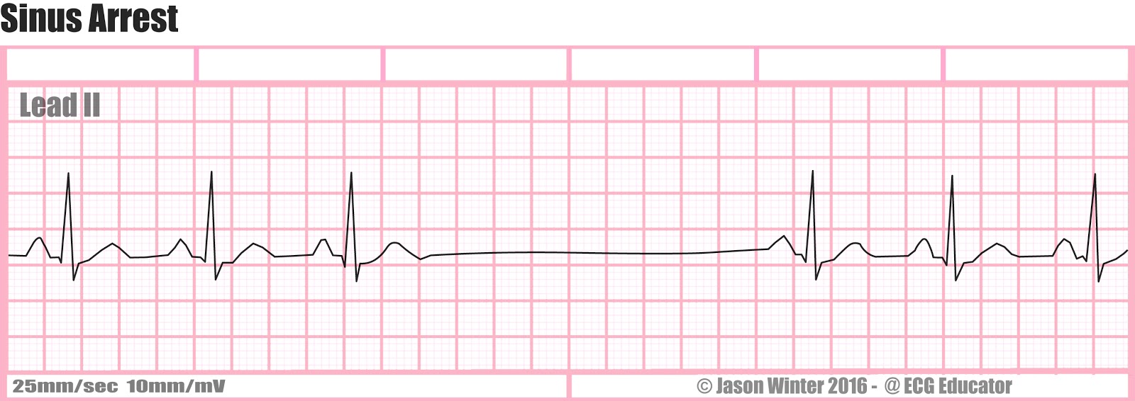ECG Educator Blog : Six Second ECG Rhythm Strips