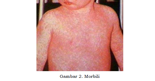 Morbili ~ Panduan Praktik Dokter di Fasilitas Pelayanan Kesehatan Primer