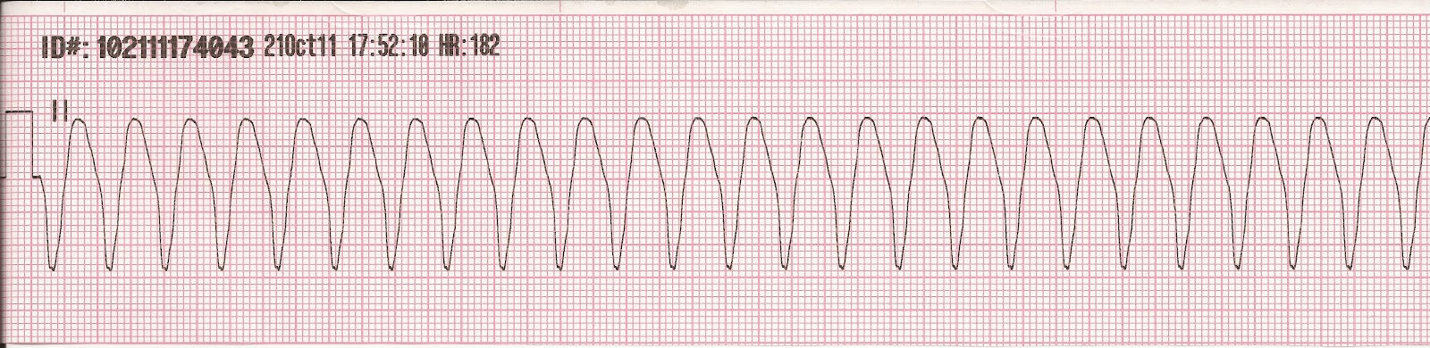 EKG Rhythm Strips 03