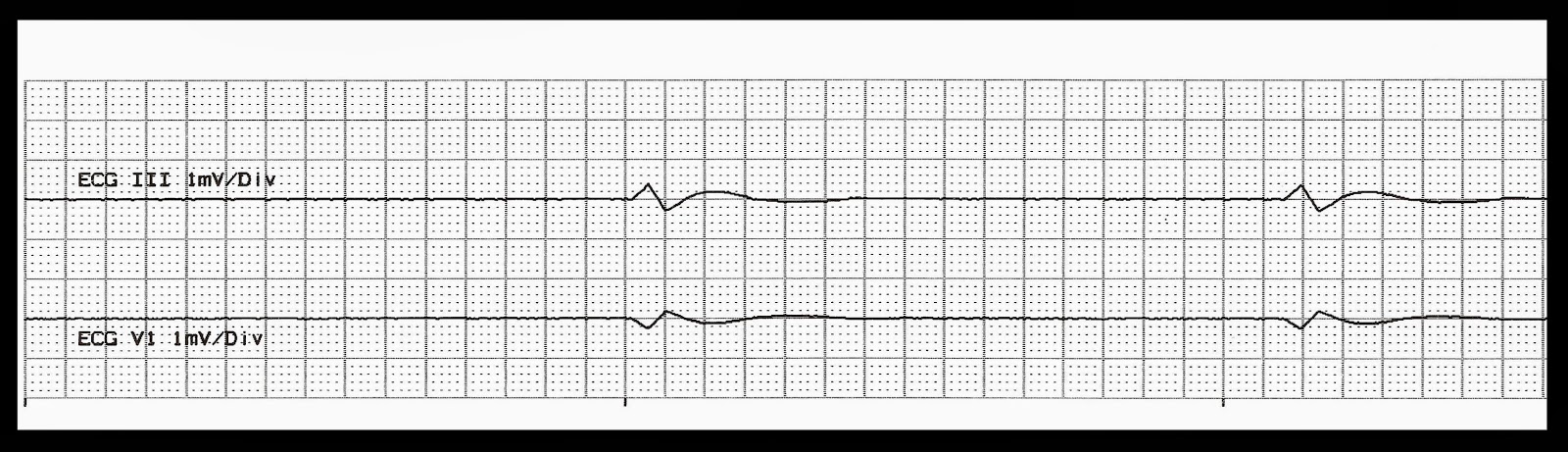 Basic EKG Rhythm Test 20