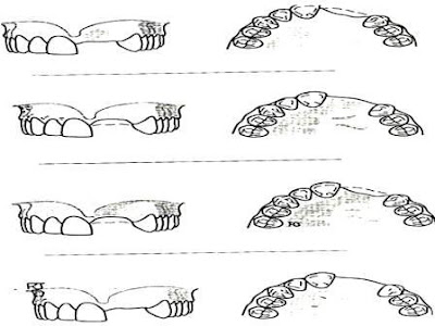 PROTESIS DENTAL : PONTICO