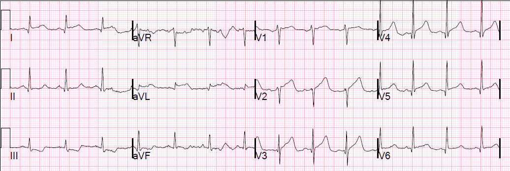 Dr. Smith's ECG Blog: STEMI: Which coronary artery is occluded?