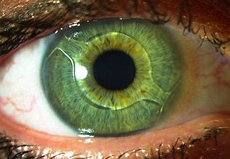 An Intro to Refractive Surgery Options - Eyedolatry