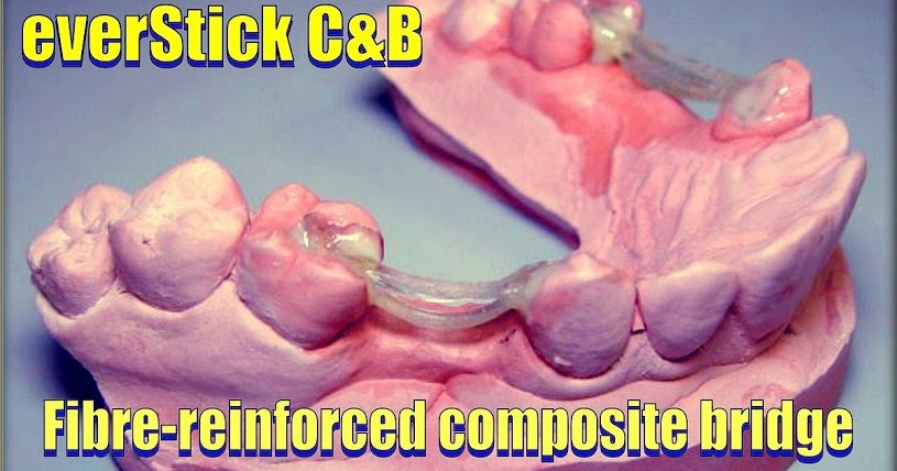 DENTAL MATERIALS: Fibre-reinforced composite bridge with everStick C&B - posterior - Odonto-Tv
