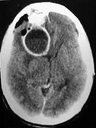 Blog Dr. Carlos: Abscesso cerebral