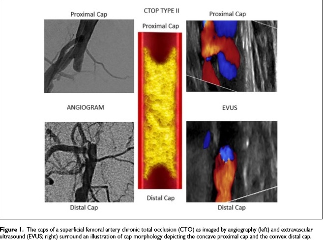 Vascular Mind : CHRONIC TOTAL OCCLUSION CROSSING APPROACH BASED ON ...