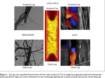 Vascular Mind : CHRONIC TOTAL OCCLUSION CROSSING APPROACH BASED ON ...
