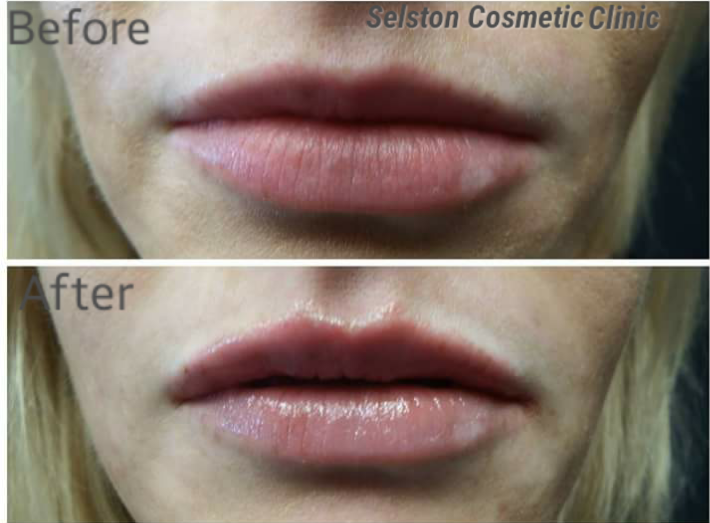 Selston Cosmetic Clinic: Improve Flat & Unbalanced Lips with Lip Filler ...