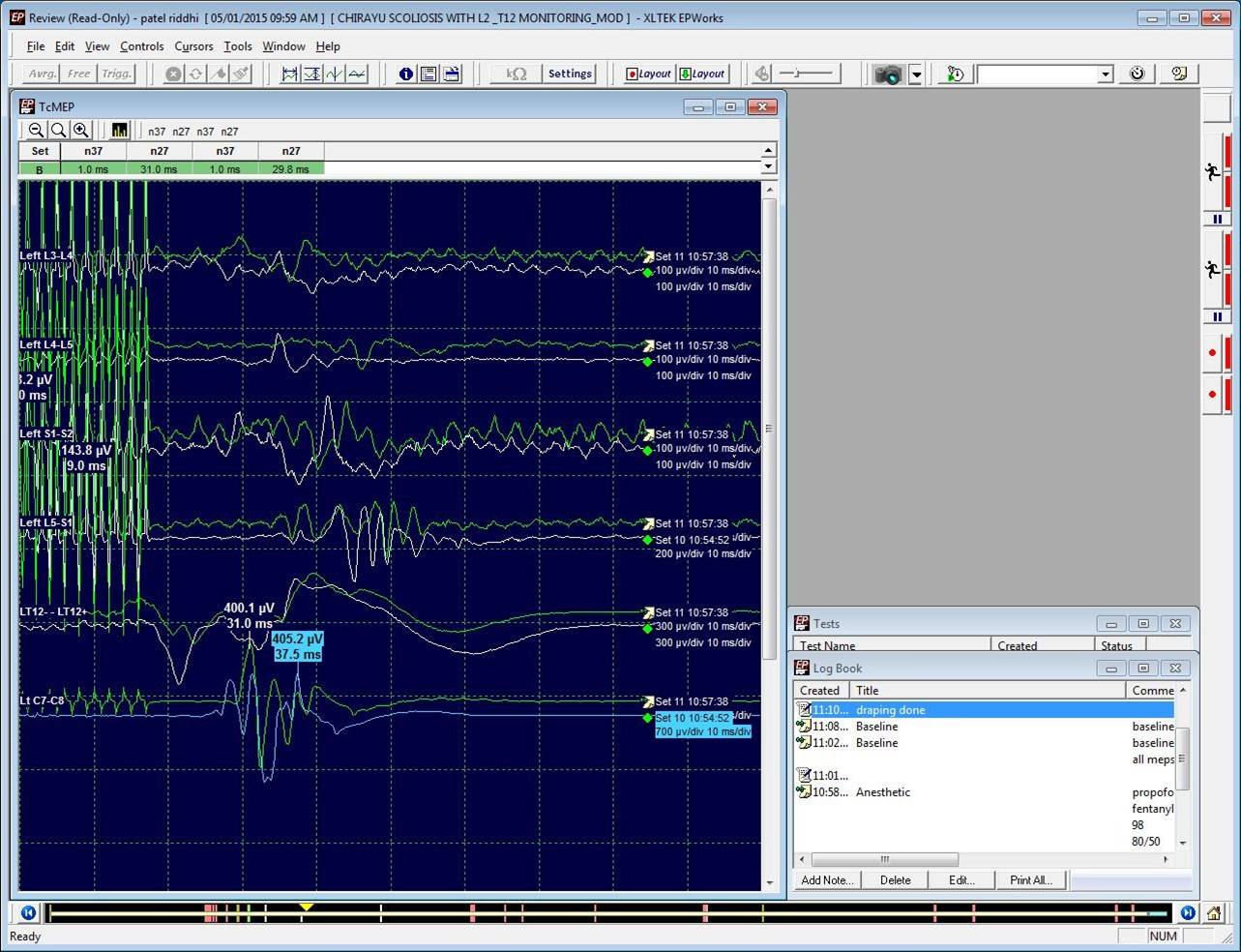 nehal: INTRAOPERATIVE NEUROMONITORING - A BRIEF OVERVIEW