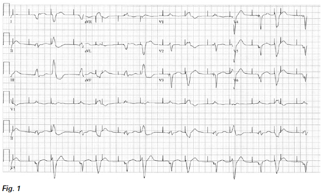 Focus on ECGs: Case #2 - Evaluation of Suspected Device Malfunction on ECG