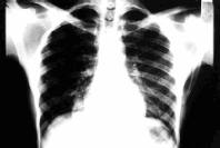 carlossqutesa@blogspot.com: EXAMEN DE TÓRAX