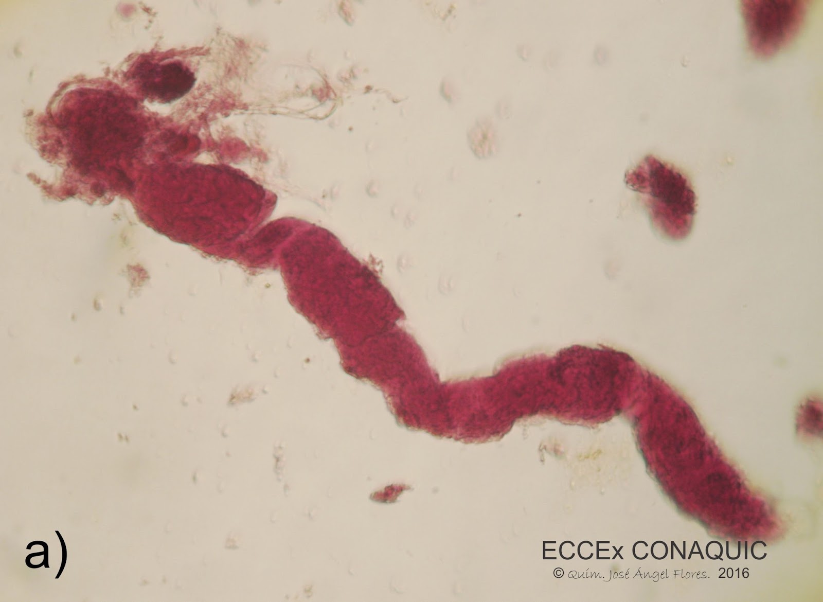 Caso UR-enero-16 (Enfoque: cilindruria)