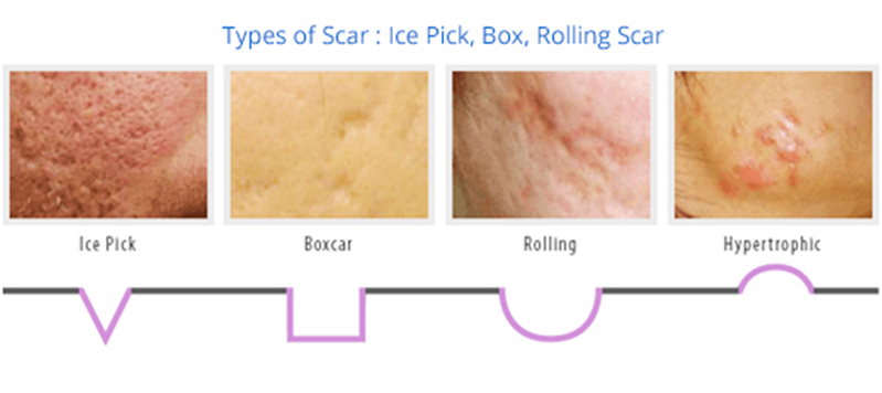 Different Types of Acne Scars