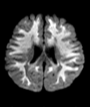 Leukodystrophy Teaching Points-MRI - Sumer's Radiology Blog