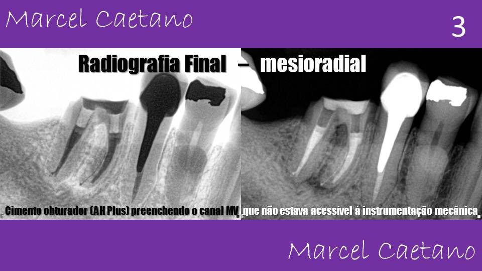 Endodontia Avançada: Anatomia radicular como fator dificultante para ...
