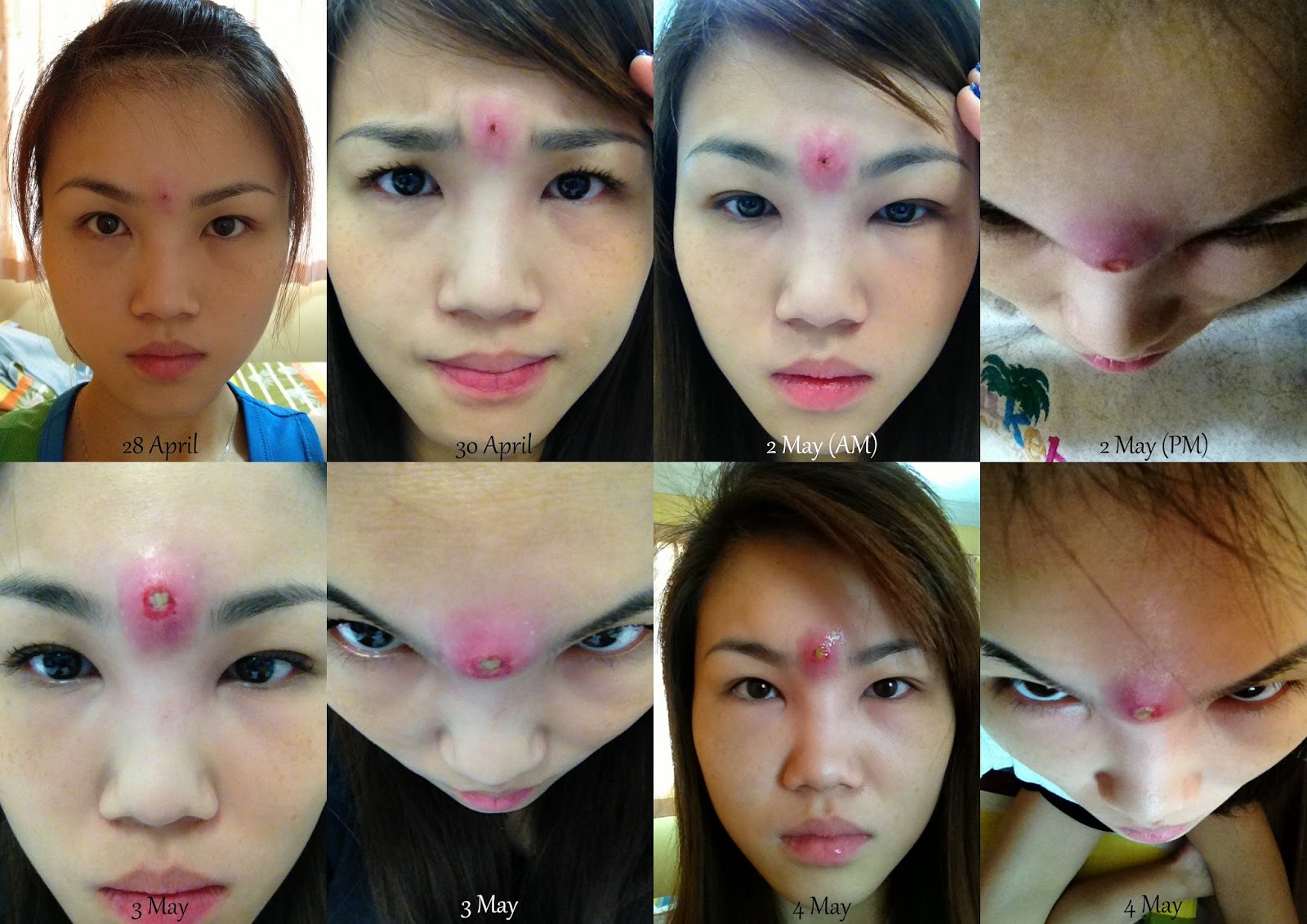 ~*May Anne's Idiosyncrasies*~: Massive Boil!