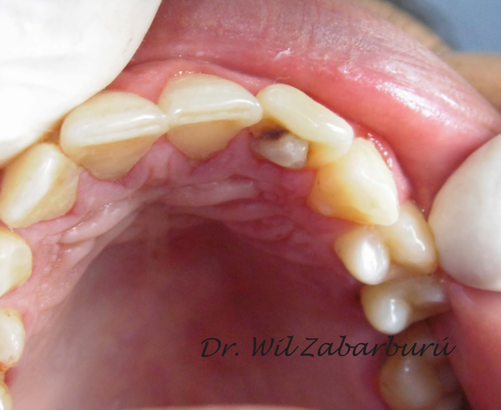 CLINICA DENTAL ASISTENCIAL: TALÓN CUSPÍDEO